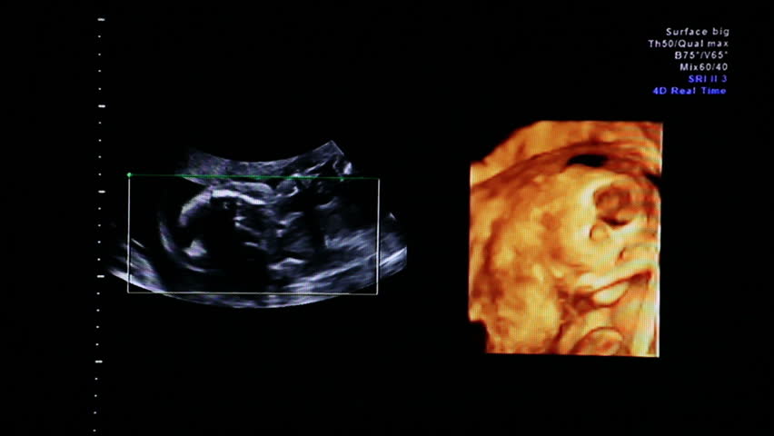 4D Ultrasound Ecography. Gynecological Medical Examination. 22 Weeks ...