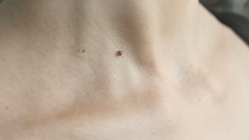 Parasite Under Skin Humans