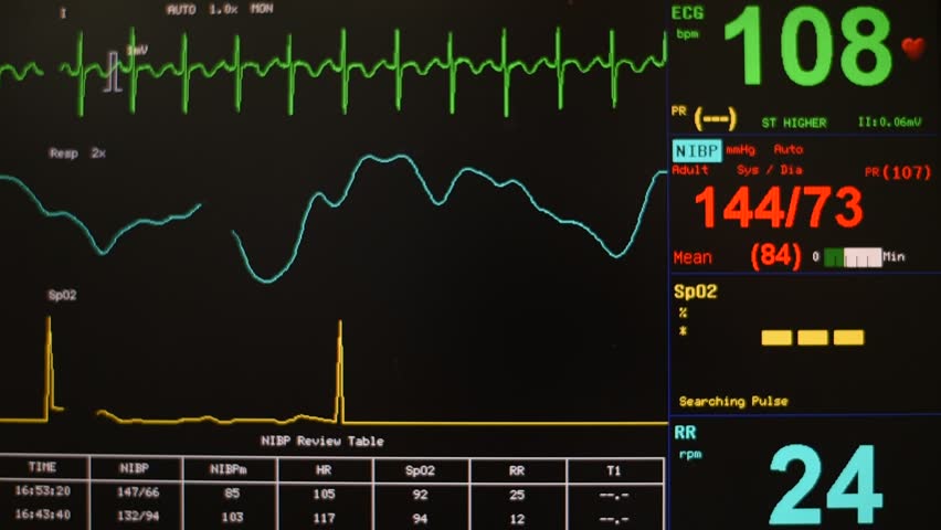 EKG Monitor In ICU Unit Show The Waves Of Blood Pressure, Blood Oxygen ...