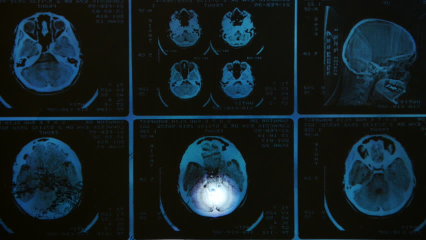 Glowing and Radiant Mri Scan Stock Footage Video (100% Royalty-free ...