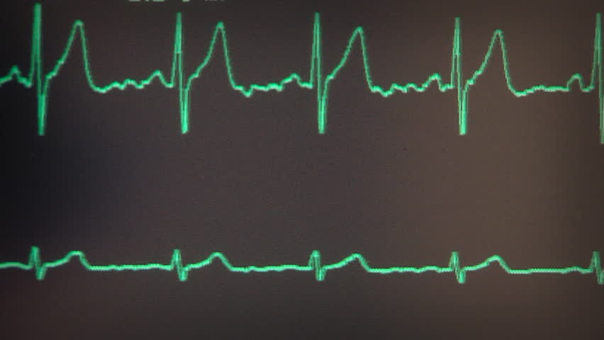 Animation Of Schematic Diagram Of Normal Sinus Rhythm For A Human Heart ...